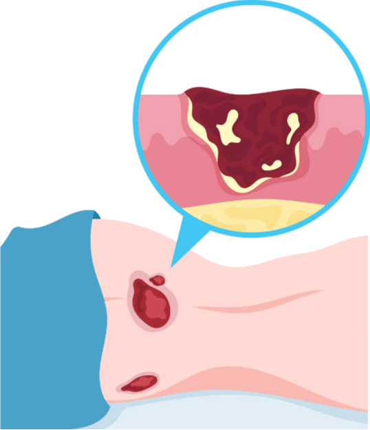 Helping Prevent Pressure Injuries with Therapeutic Support Surfaces